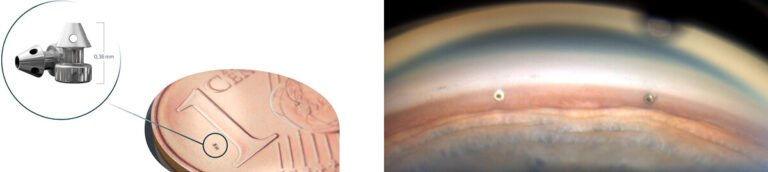 Glaucoma Des Moines | iStent Glaucoma Treatment Des Moines